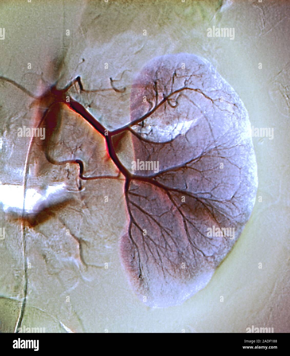 Kidney blood vessels. Coloured angiogram (blood vessel X-ray) of the ...