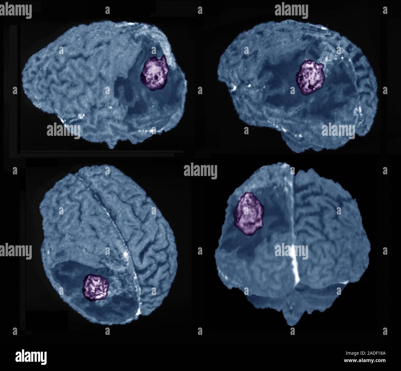 Recurrent glioma brain tumour. Coloured 3D magnetic resonance imaging (MRI) scans of the brain ...