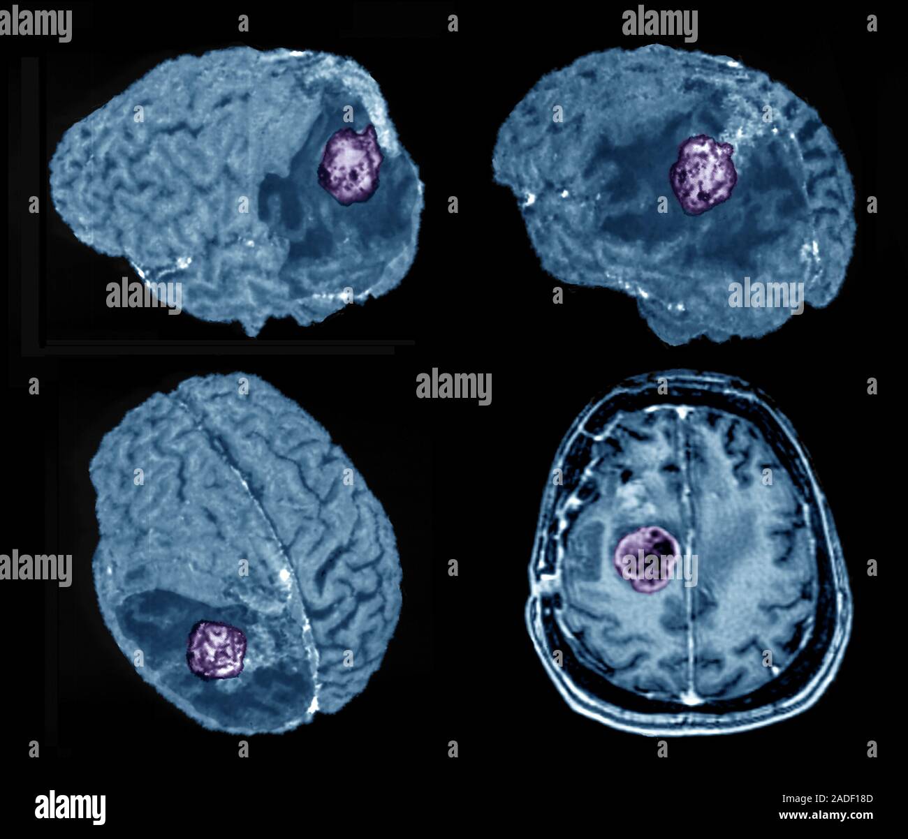 Recurrent glioma brain tumour. Coloured 3D and 2D magnetic resonance imaging (MRI) scans of the ...