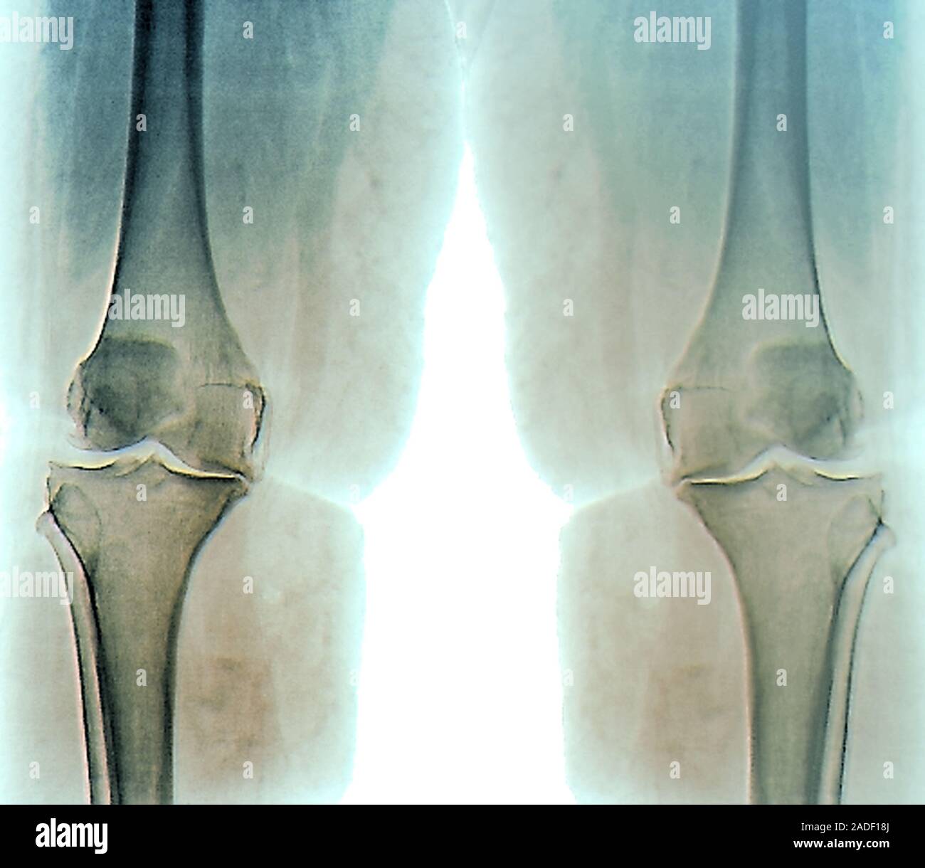 Knee osteoarthritis in obesity. Coloured frontal X-ray of the knees of ...