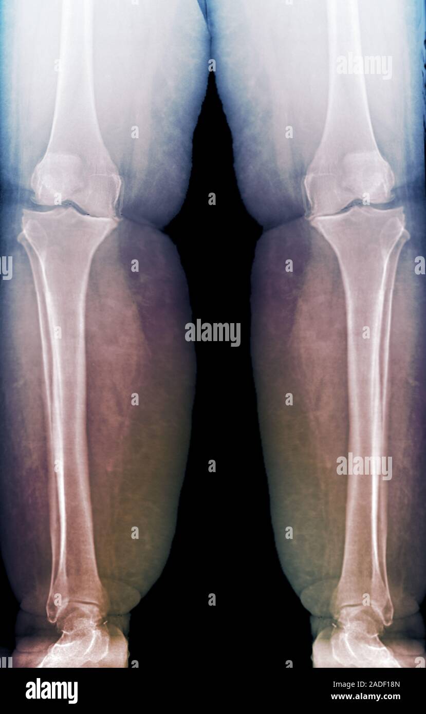 Knee osteoarthritis in obesity. Coloured frontal X-ray of the knees and ...