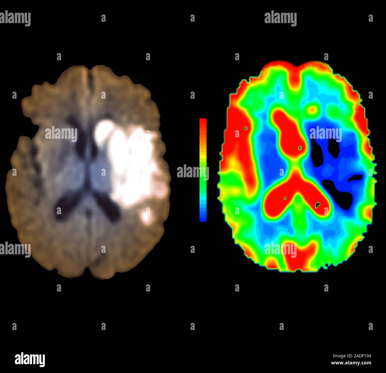 Brain damage due to a stroke. Coloured axial magnetic resonance imaging ...