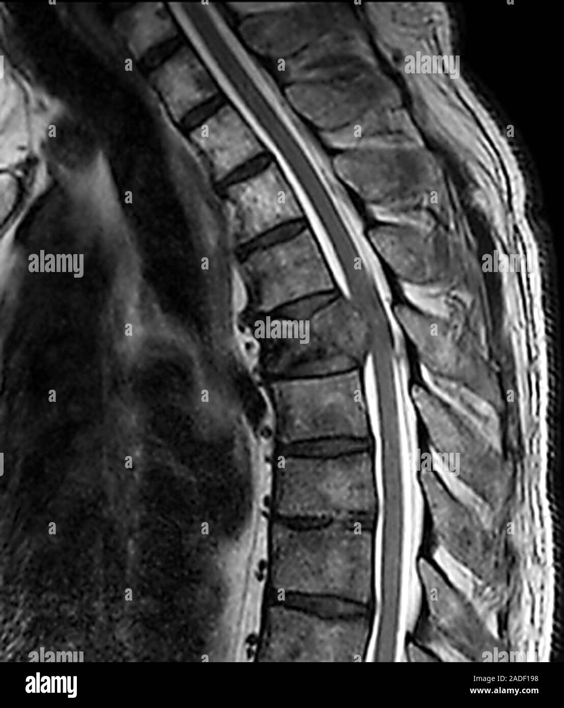Secondary bone cancer in the spine. Sagittal magnetic resonance imaging ...