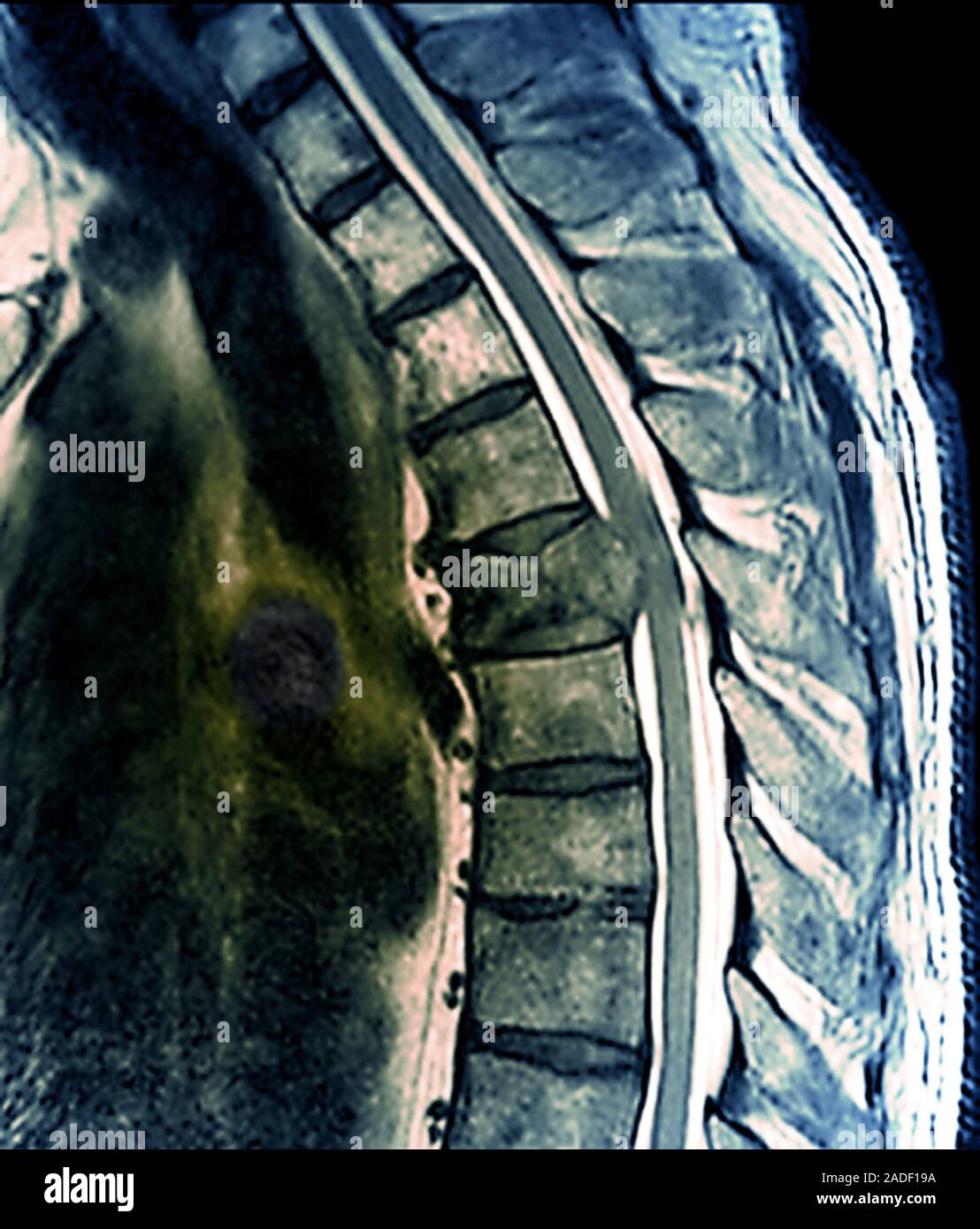 Secondary bone cancer in the spine. Sagittal magnetic resonance imaging ...