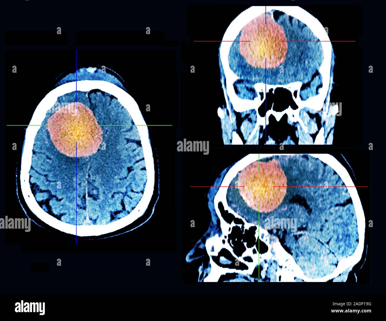 Meningioma brain cancer. Coloured computed tomography (CT) scans through the brain of an 87-year ...