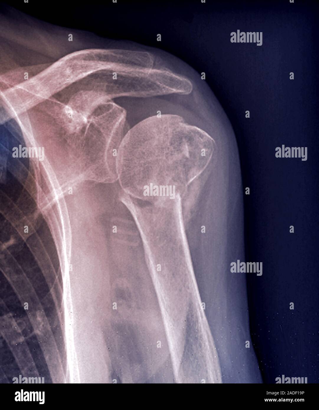 Broken upper arm bone. Coloured frontal X-ray of the fractured left ...