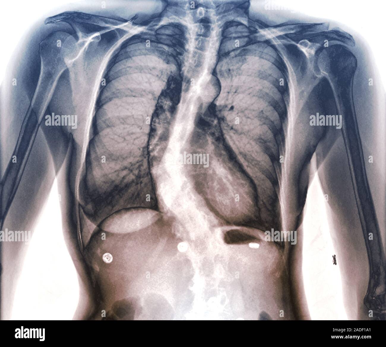 Scoliosis. Coloured X-ray of the backbone of a 74-year-old woman with ...