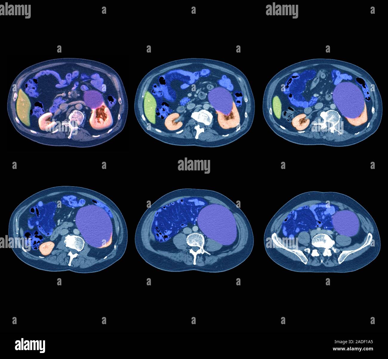 Kidney cyst. Coloured axial computed tomography (CT) scans through the abdomen of a 52-year-old ...