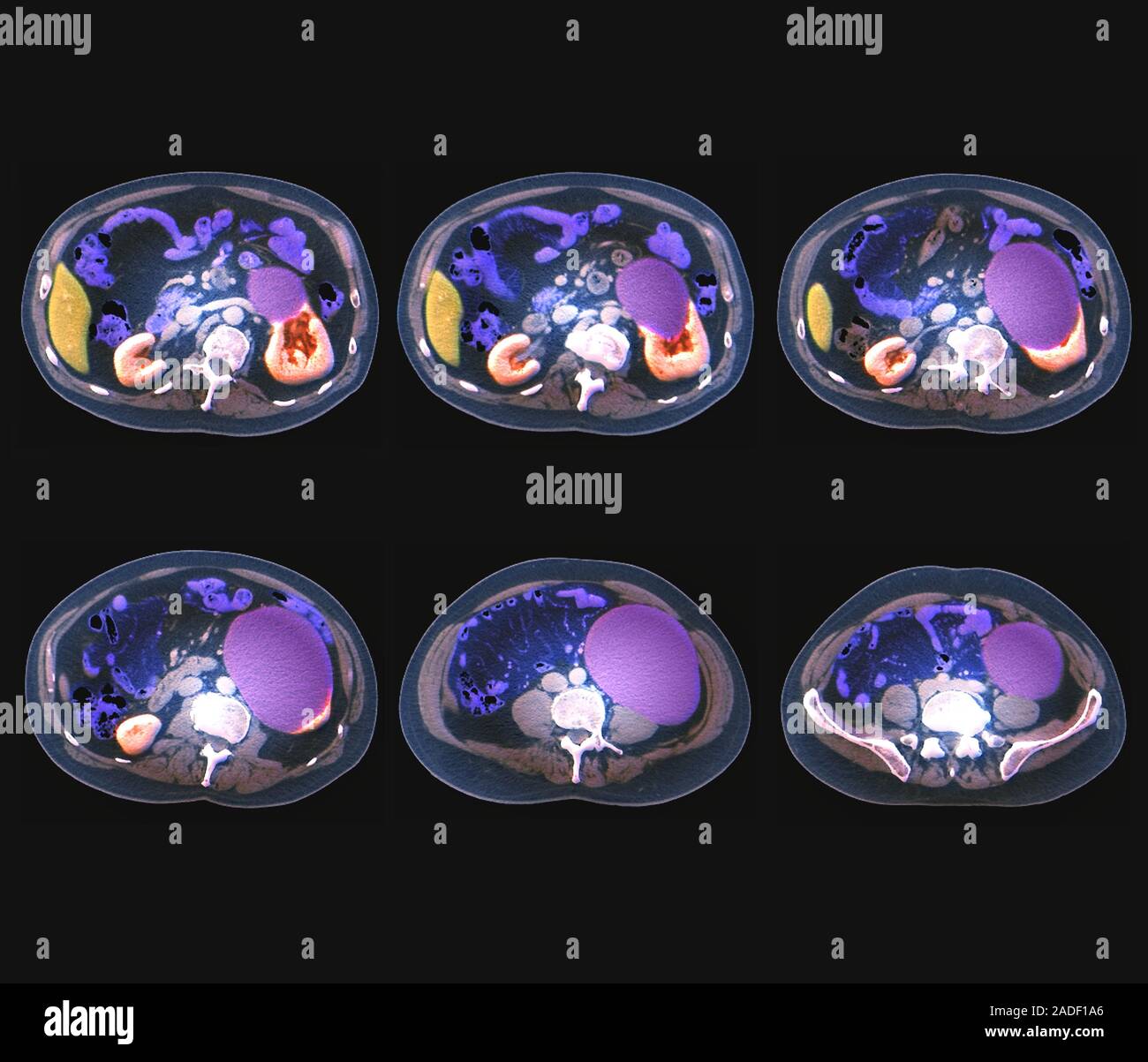 Kidney cyst. Coloured axial computed tomography (CT) scans through the abdomen of a 52-year-old ...