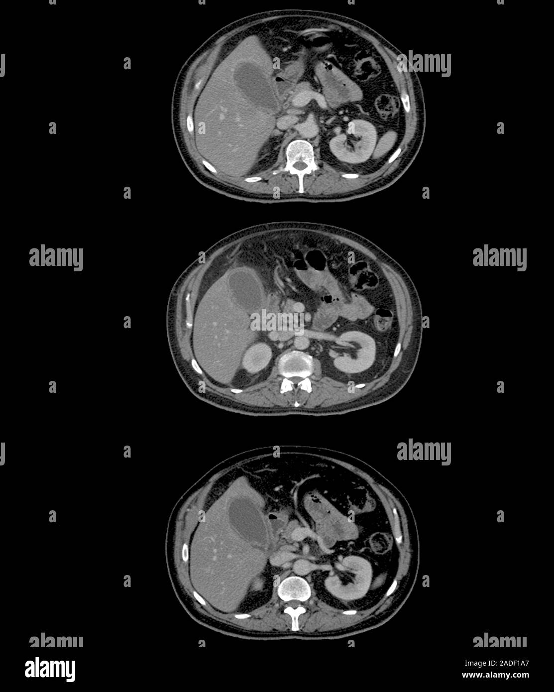 Gallbladder inflammation. Axial computed tomography (CT) scans through ...
