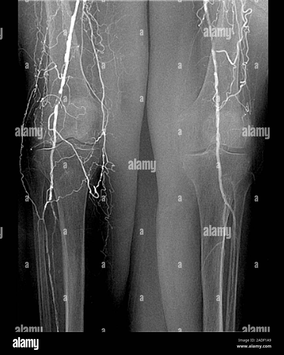 Nearly blocked femoral arteries. Frontal angiogram (blood vessel X-ray ...