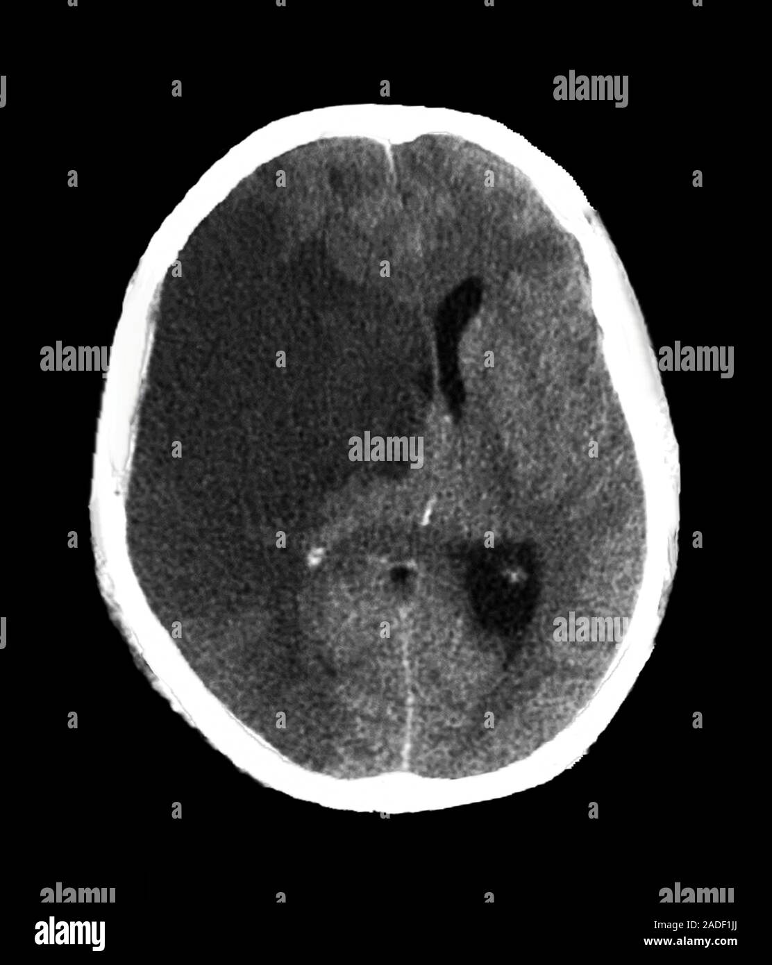 Stroke and brain damage. Axial computed tomography (CT) scan through ...