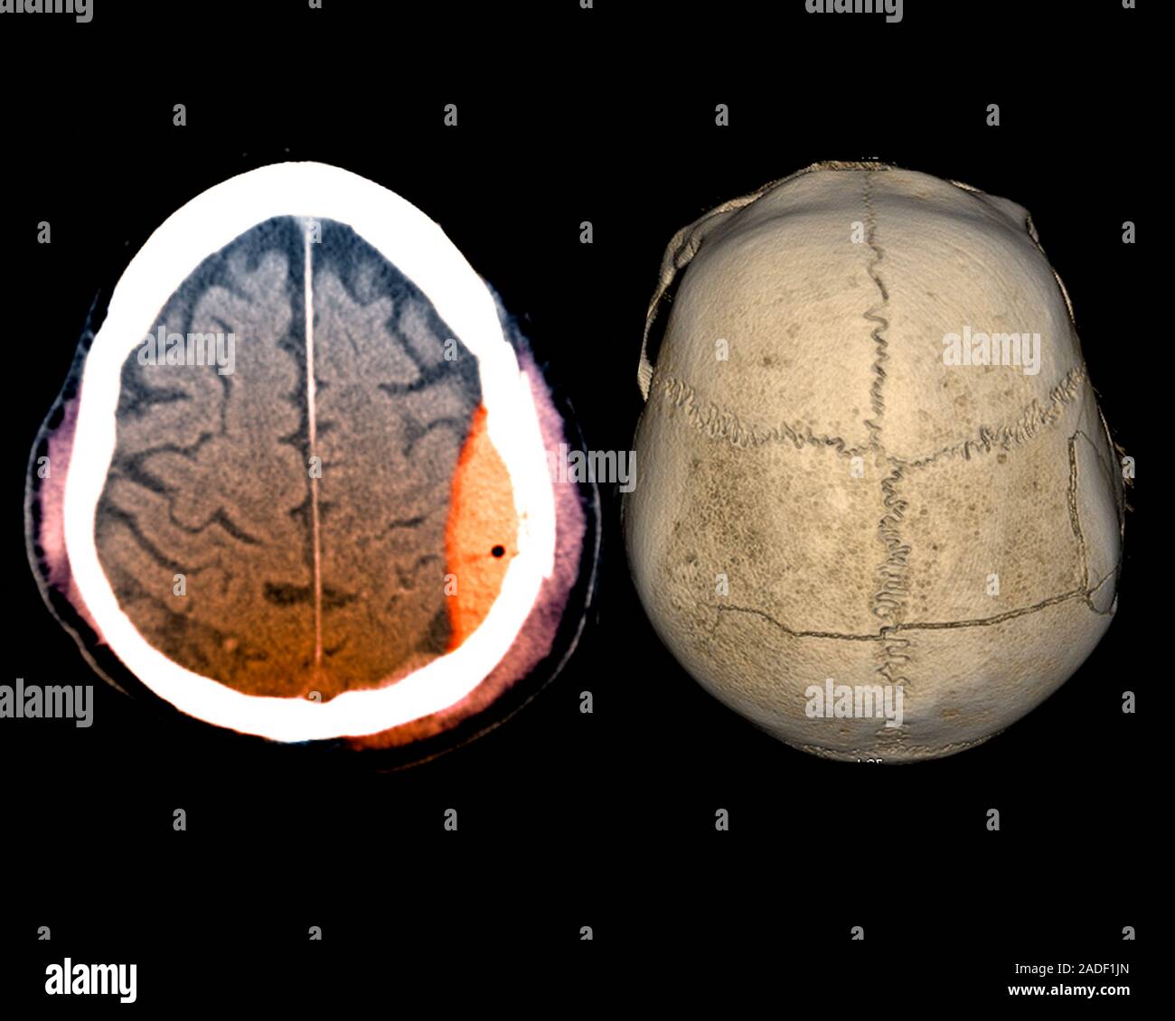 Skull fractures. Coloured 2D (left) and 3D (right) computed tomography ...