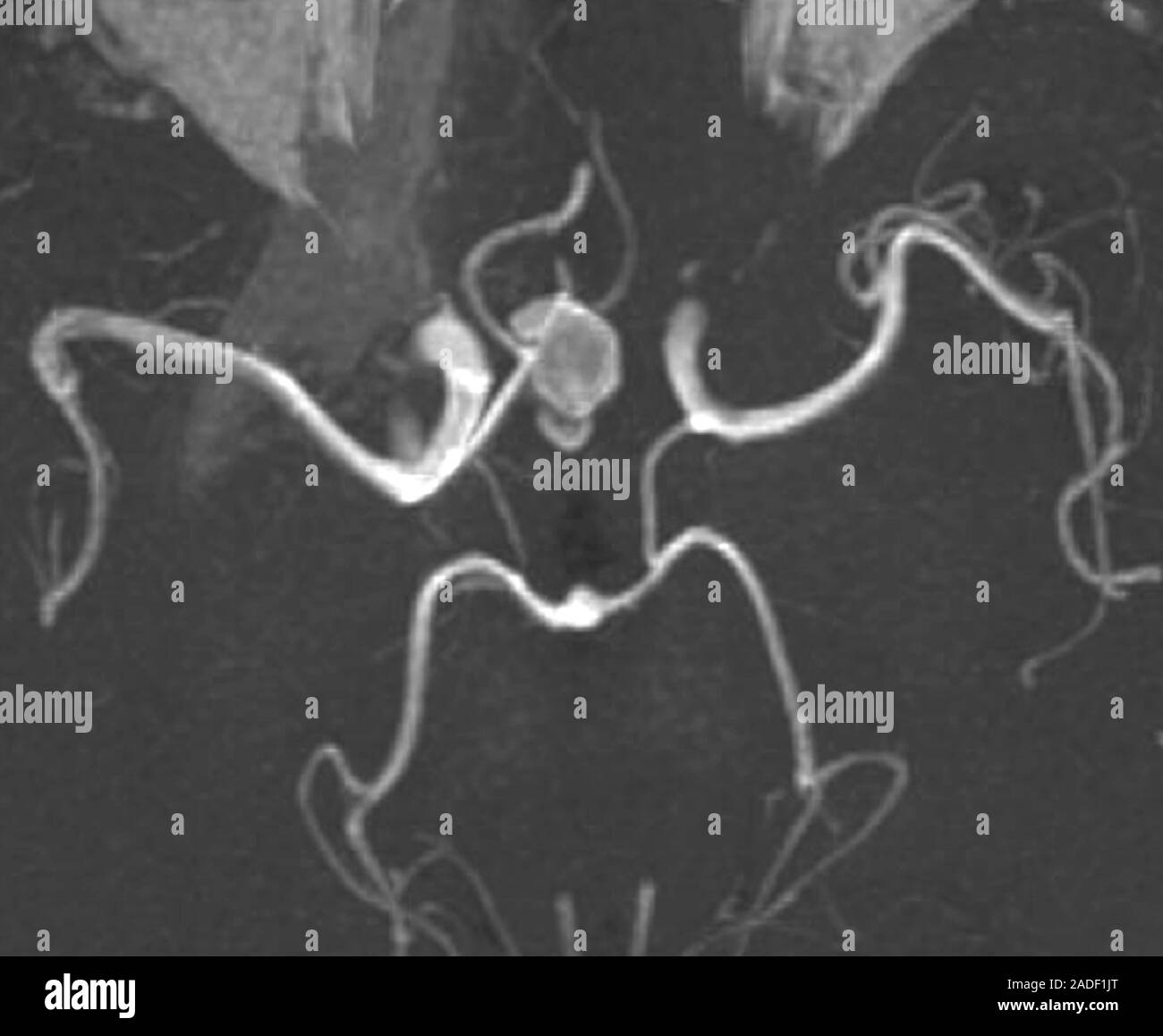 Cerebral haemorrhage and aneurysm. Computed tomography (CT) scan ...