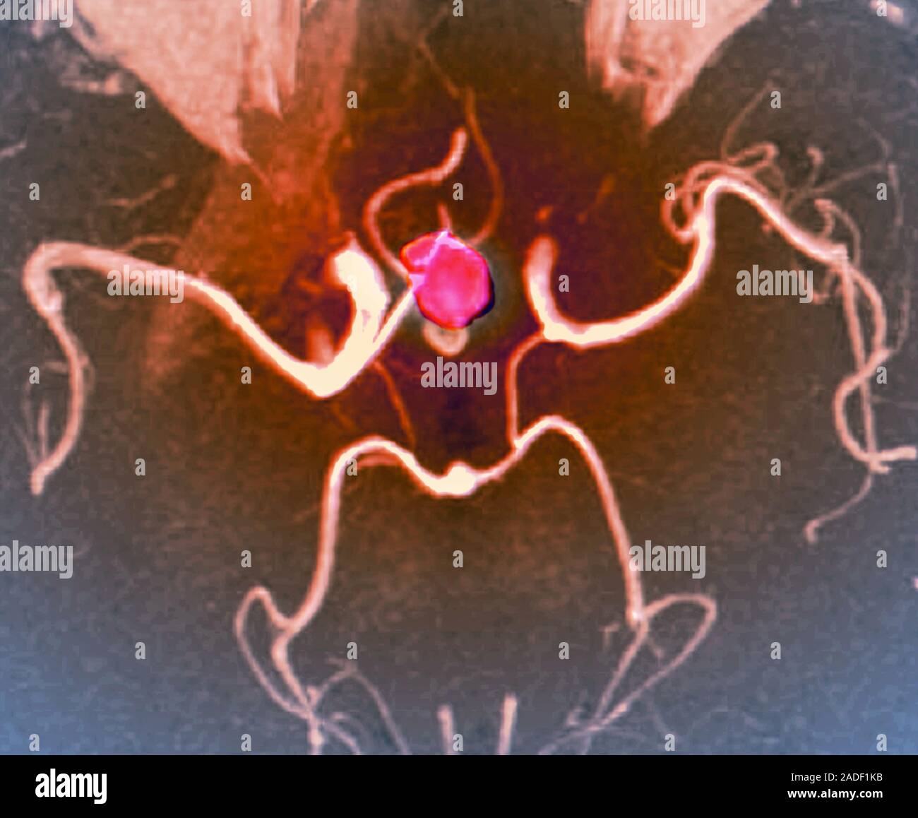 Cerebral haemorrhage and aneurysm. Coloured computed tomography (CT ...