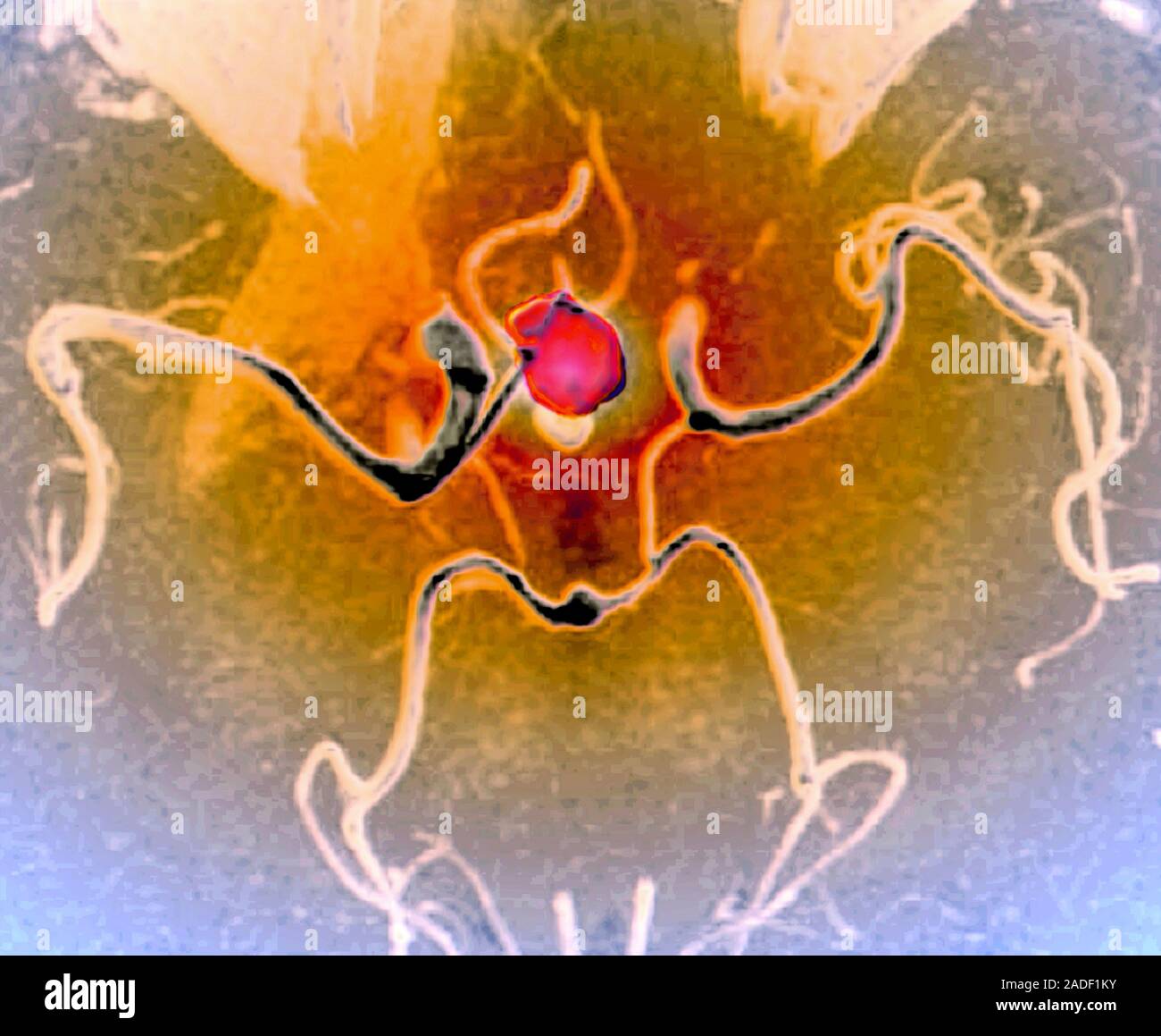 Cerebral haemorrhage and aneurysm. Coloured computed tomography (CT ...