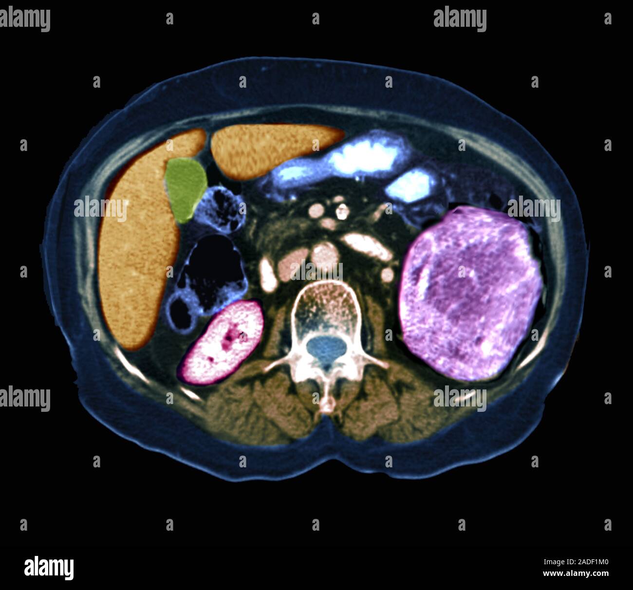 Kidney cancer. Coloured axial computed tomography (CT) scan through the ...