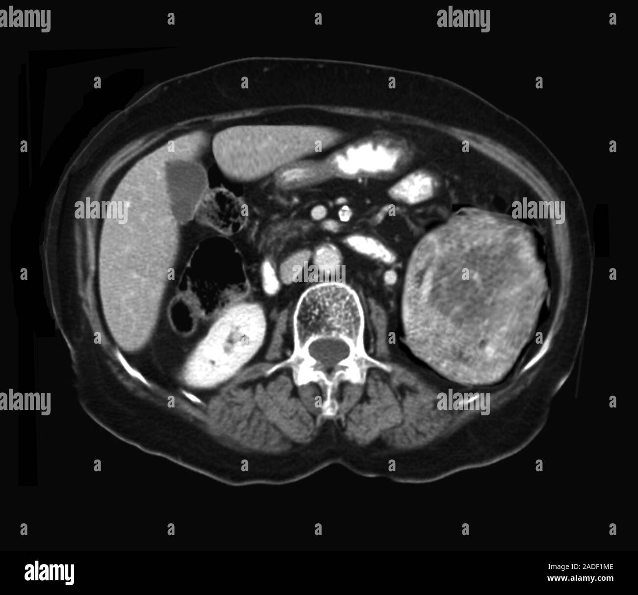 Kidney cancer. Axial computed tomography (CT) scan through the abdomen ...