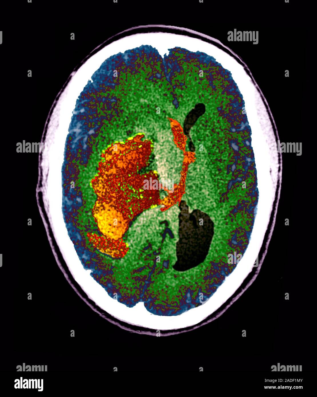 Stroke and brain damage. Coloured axial computed tomography (CT) scan through the brain of a 37 ...