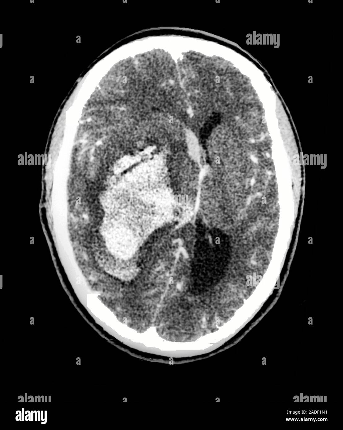 Stroke and brain damage. Axial computed tomography (CT) scan through ...