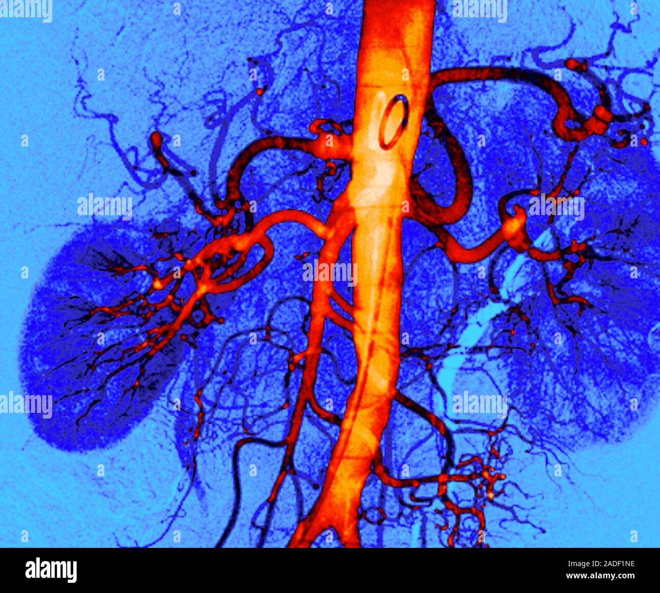 Kidney blood vessels. Coloured angiogram (blood vessel X-ray) of the ...