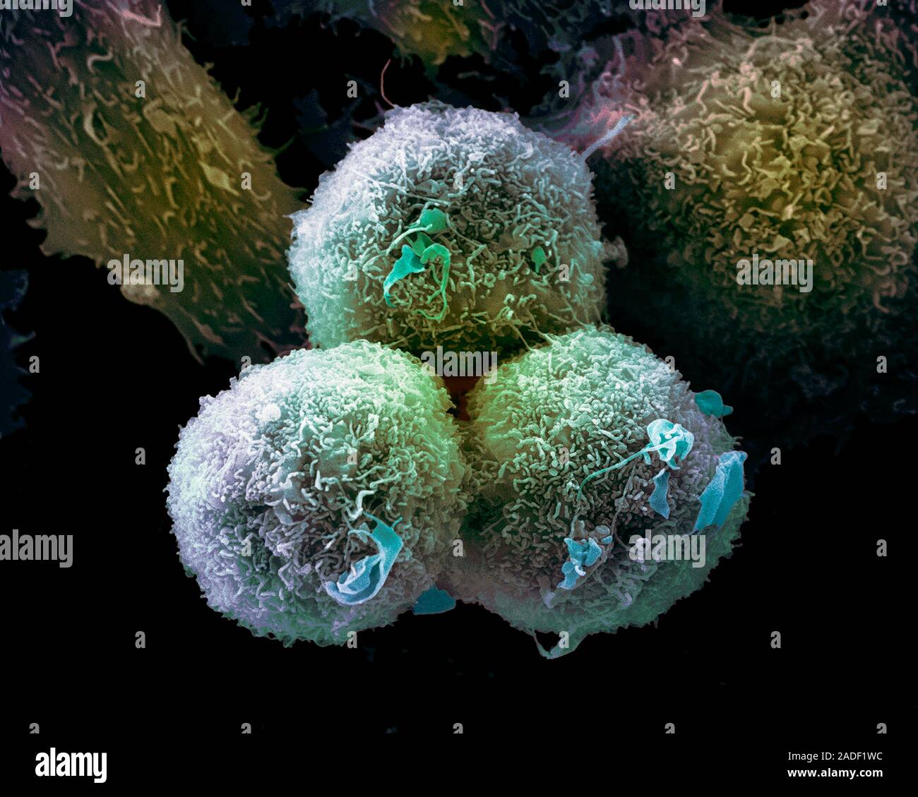 Images not to be used by the tobacco industry. Lung cancer cells ...