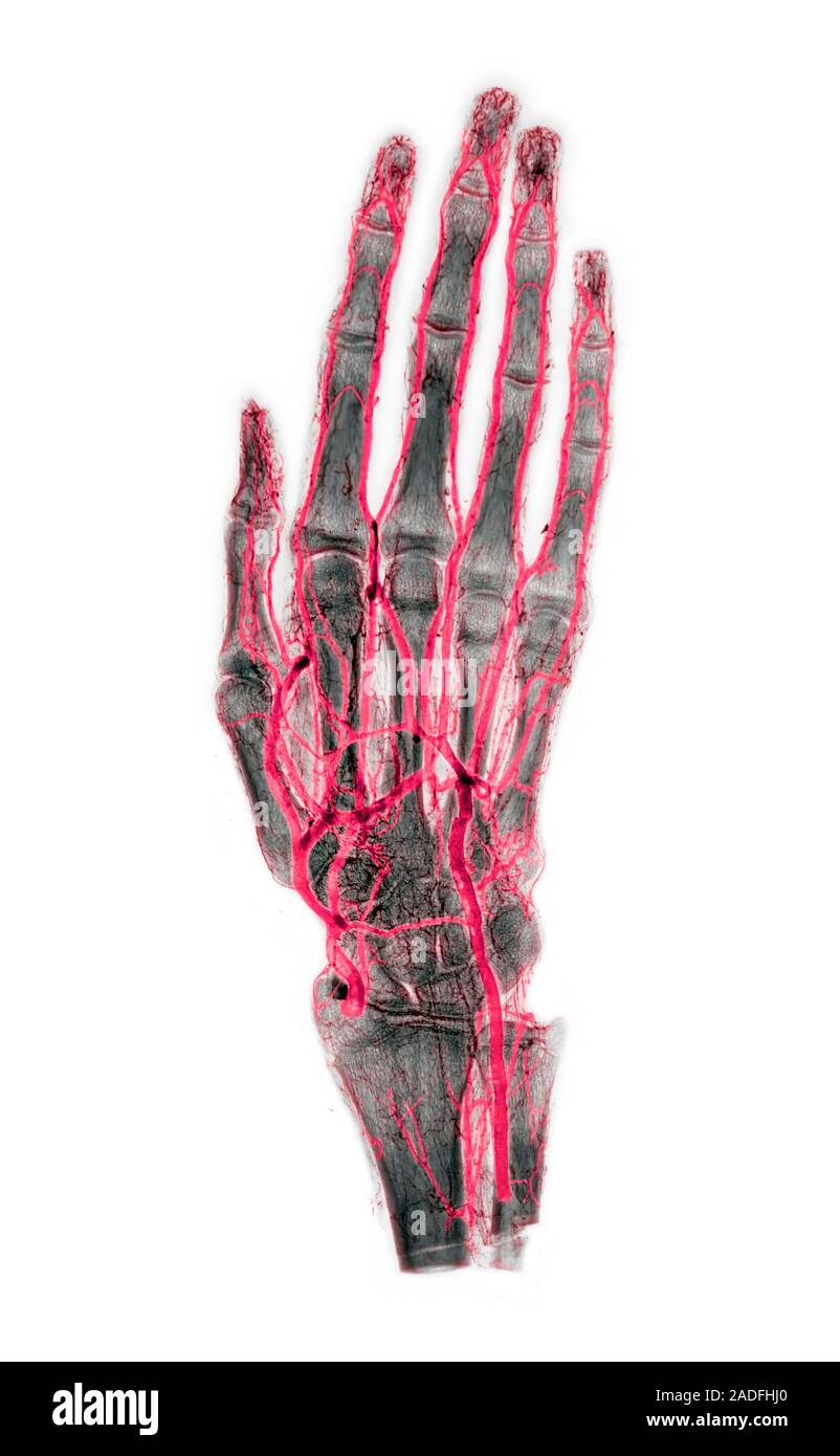 Mummified hand. Coloured angiogram of an embalmed hand, showing the ...