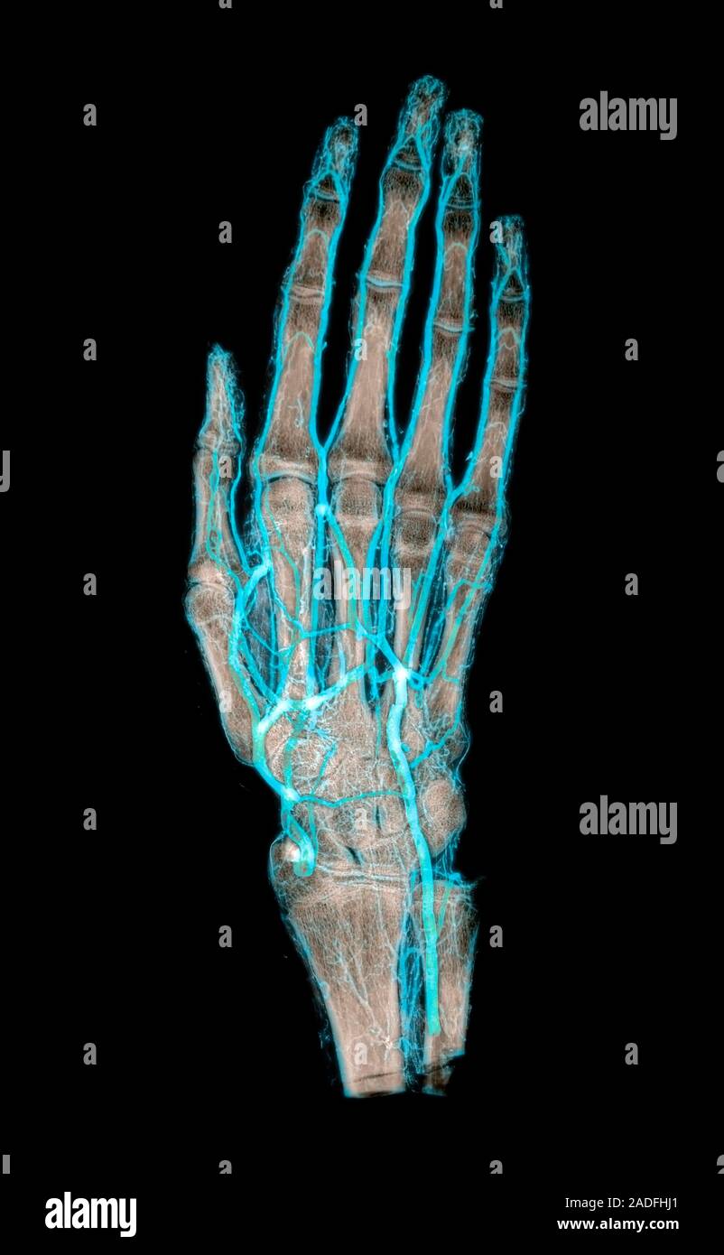 Mummified hand. Coloured angiogram of an embalmed hand, showing the ...