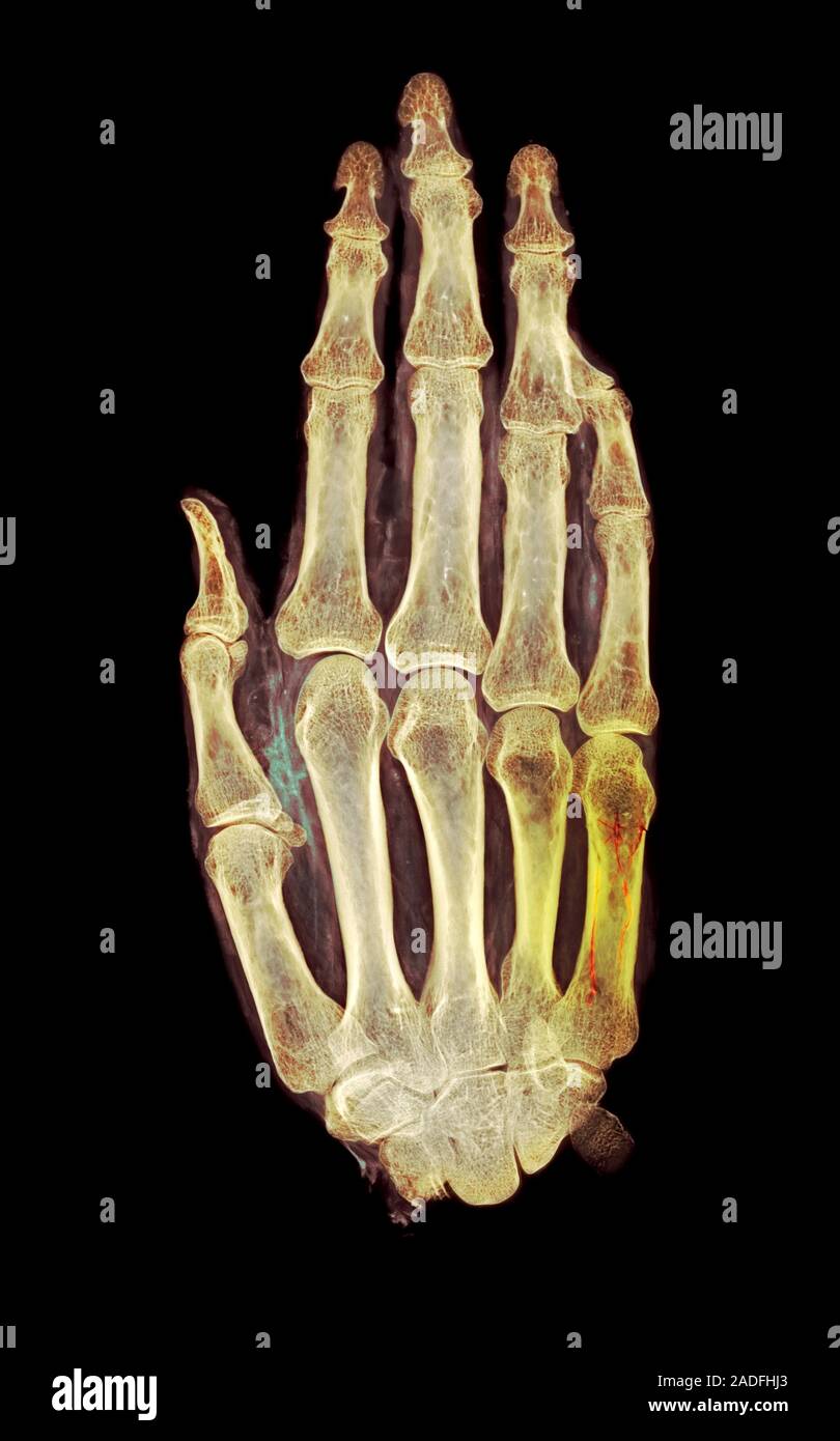 Mummified hand. Coloured X-ray of an embalmed hand, with a fractured ...