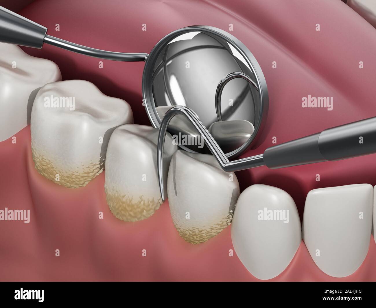 3D illustration showing dentist tools and dental plaque on model. 3D ...