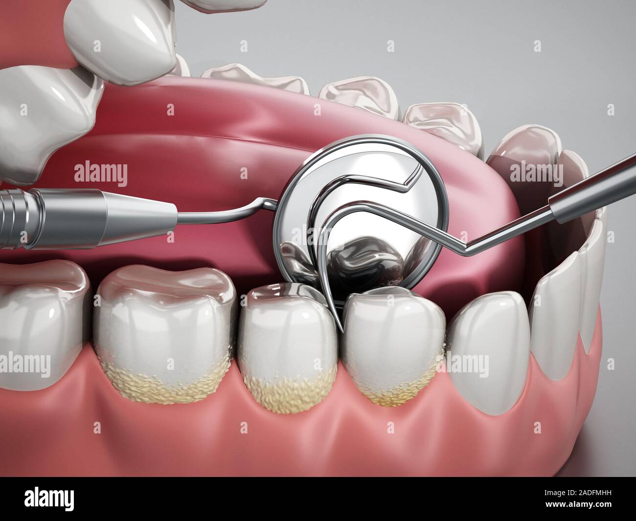 Dental plaque hi-res stock photography and images - Alamy