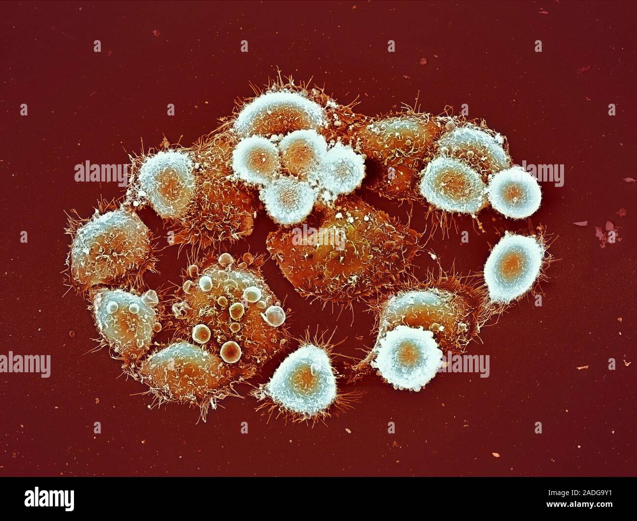 HeLa cells. Coloured scanning electron micrograph (SEM) of a colony of ...