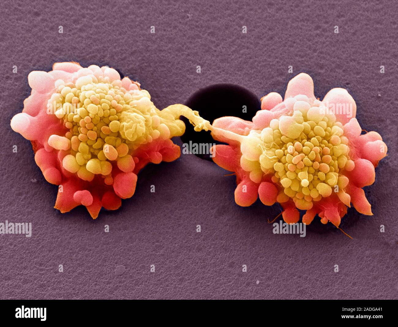HeLa cells, coloured scanning electron micrograph (SEM). The cells have ...