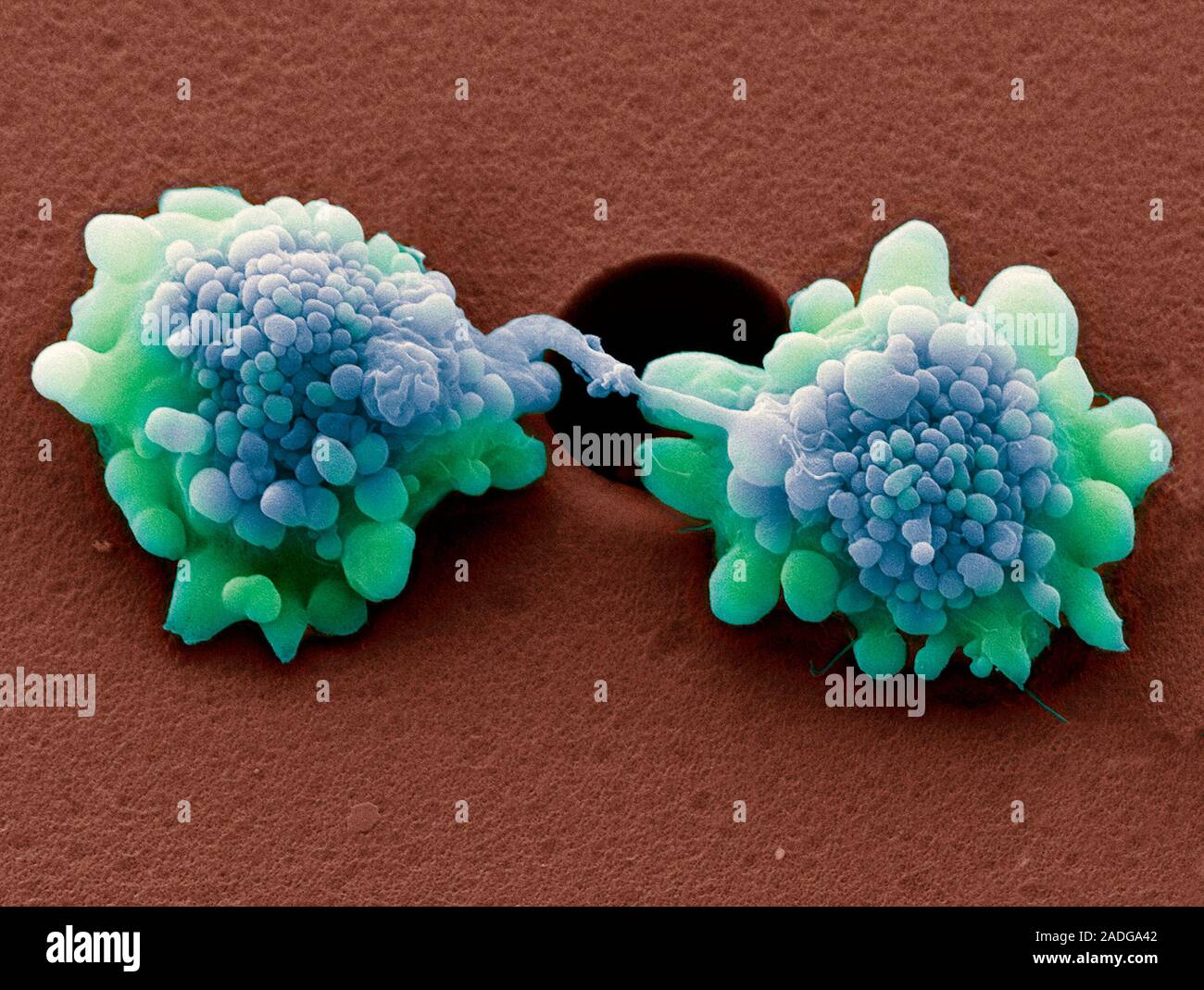 HeLa cells, coloured scanning electron micrograph (SEM). The cells have ...
