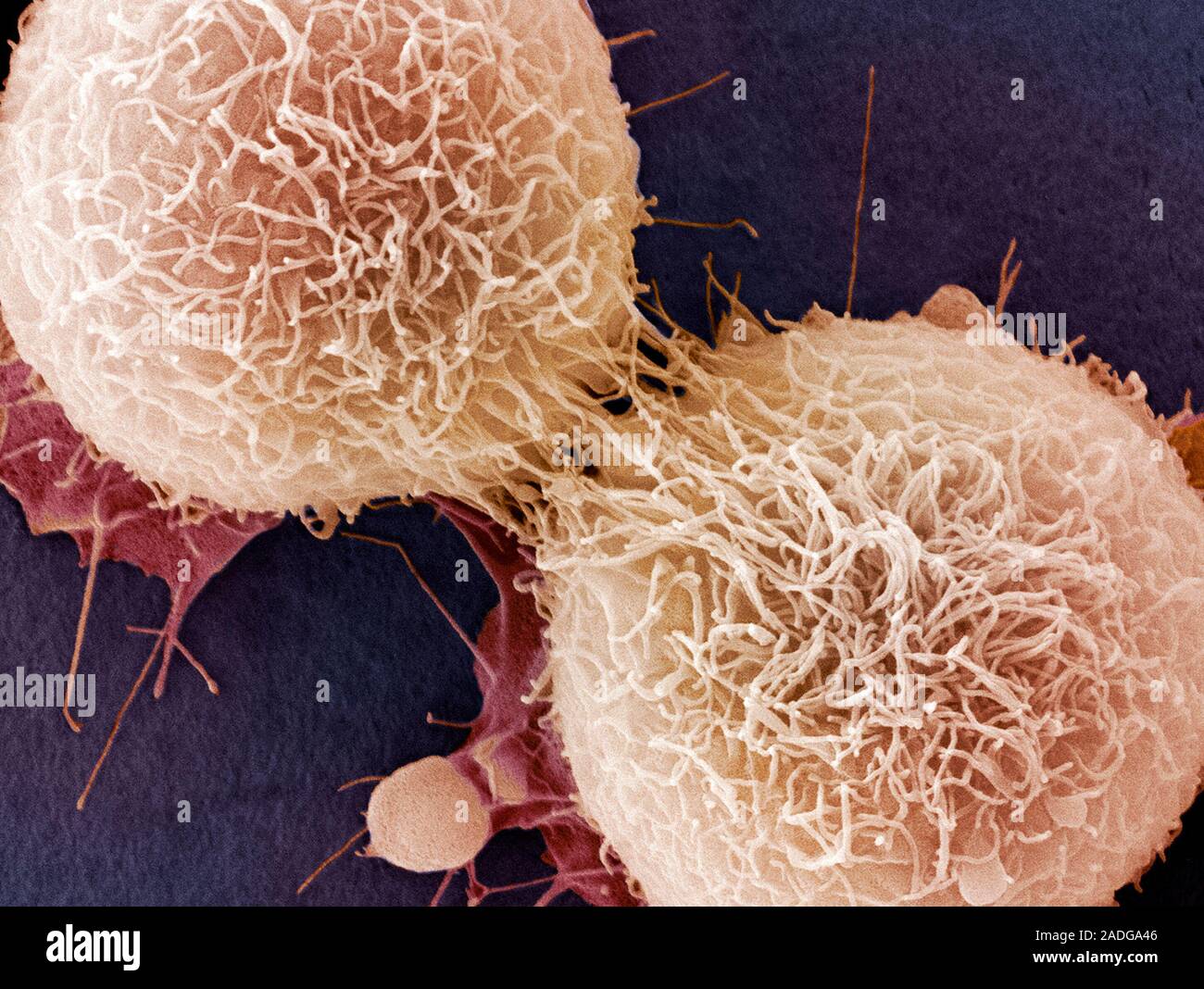 HeLa cells, coloured scanning electron micrograph (SEM). The cells have ...