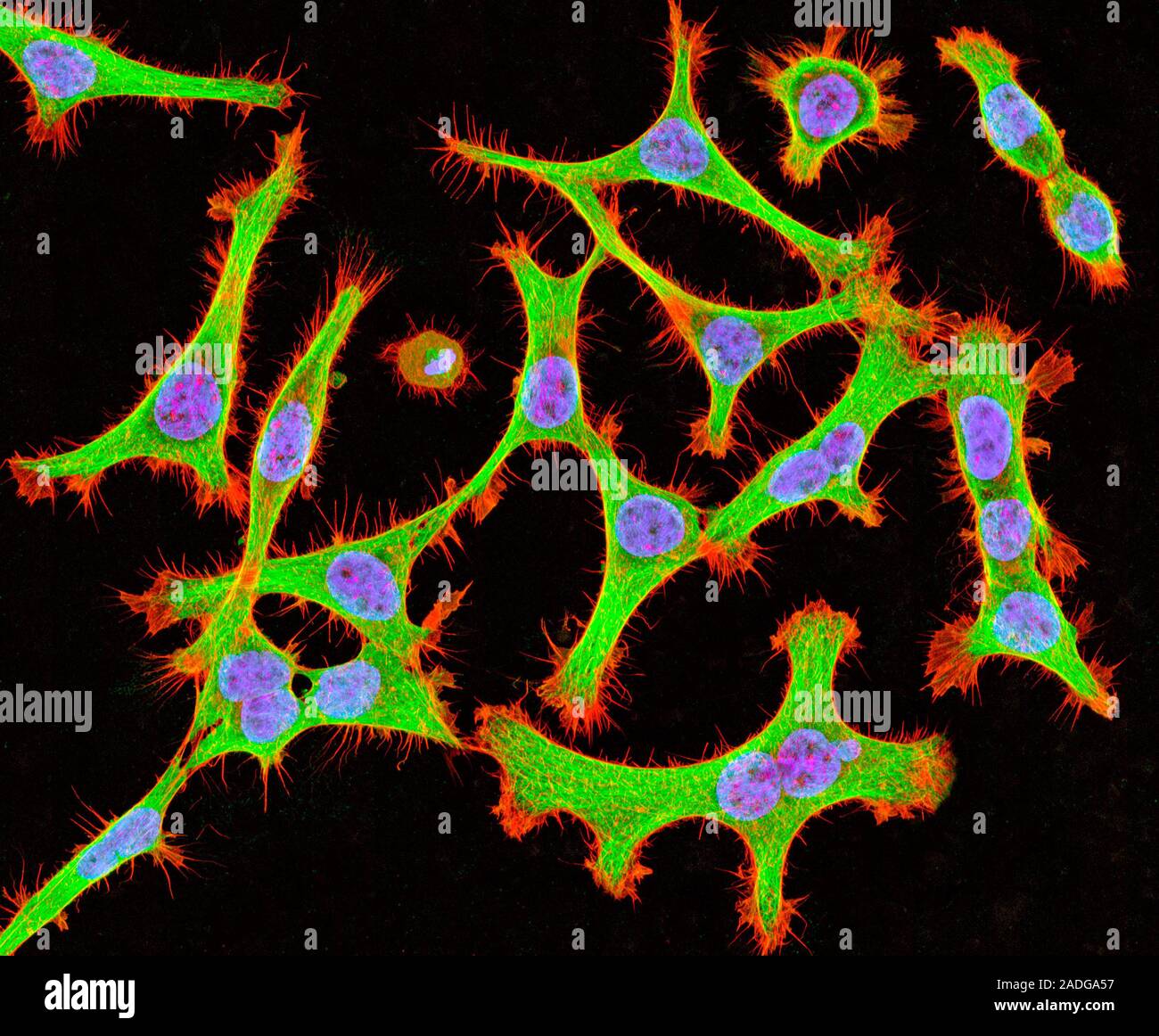 HeLa cells in culture, fluorescent light micrograph. HeLa cells are an ...