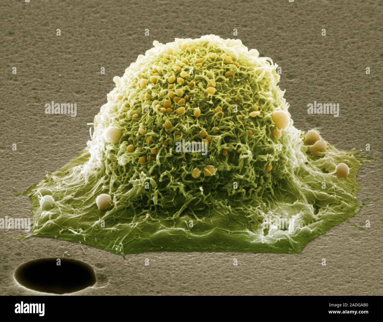 Cervical cancer cell, coloured scanning electron micrograph (SEM ...