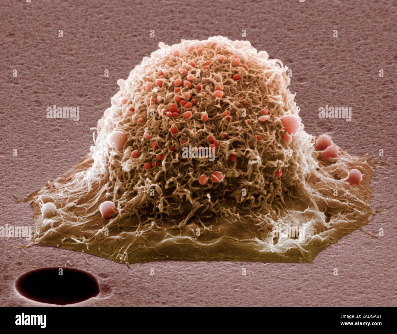 Cervical cancer cell, coloured scanning electron micrograph (SEM ... Cervical cancer cell, coloured scanning electron micrograph (SEM ...