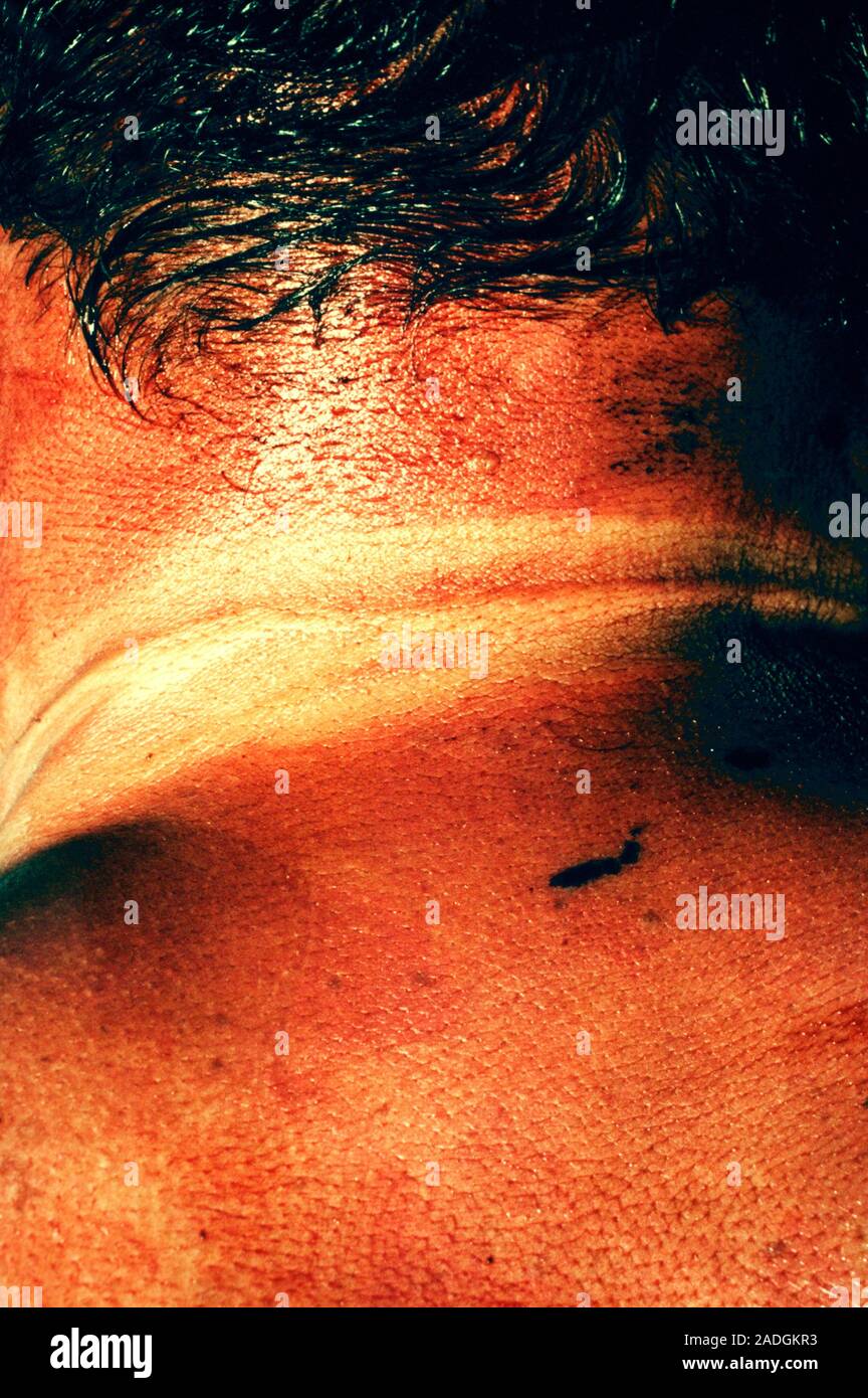 Strangulation Victims Photos