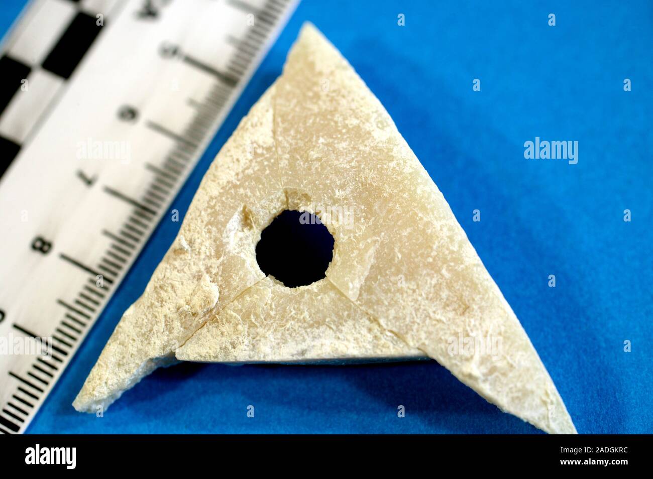 Skull bullet wound analysis. Fragment of bone from the skull of a ...