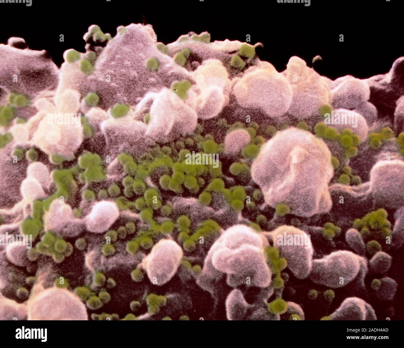 AIDS. False-colour scanning electron micrograph of a T-lymphocyte ...