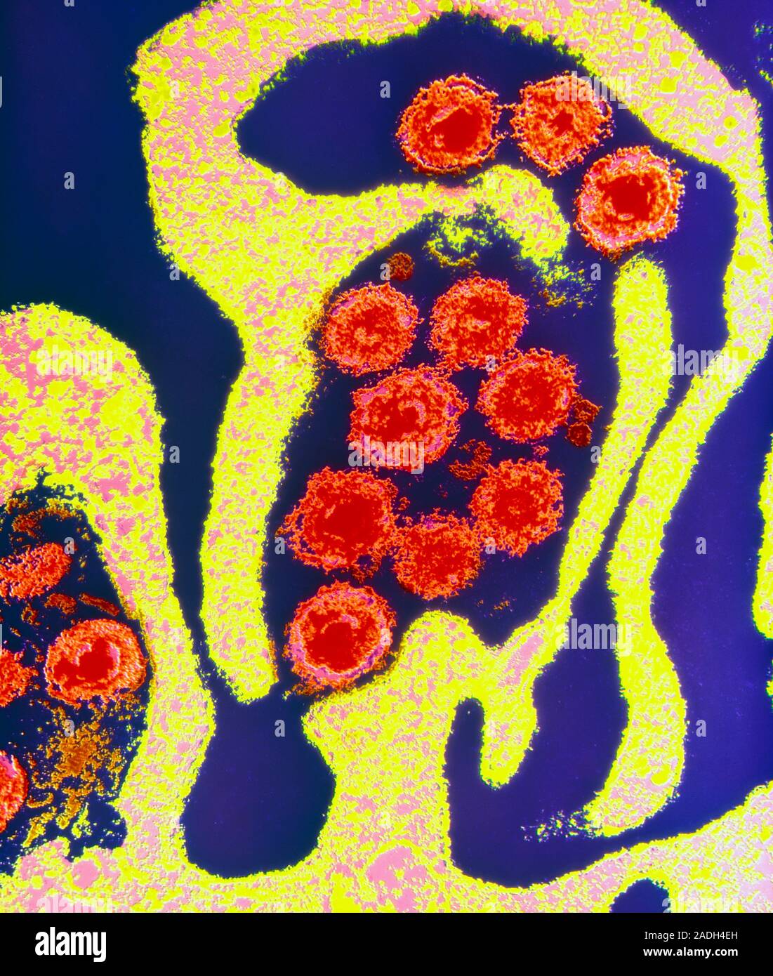 Coloured transmission electron micrograph of Human Herpes Virus type 6 ...