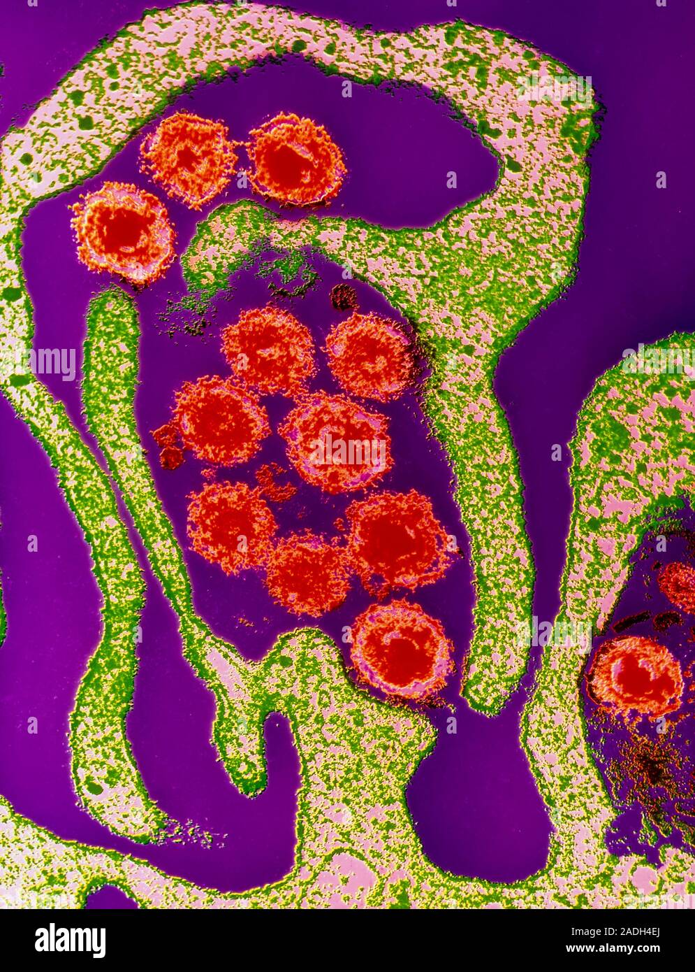 Coloured transmission electron micrograph of Human Herpes Virus type 6 ...