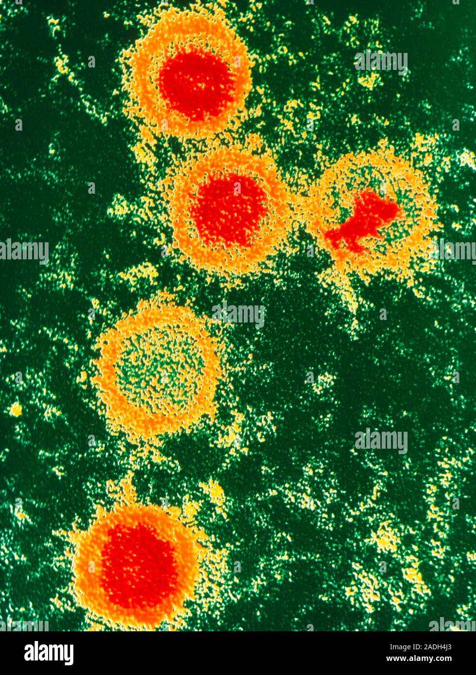 Epstein-Barr viruses, EBV. Coloured transmission electron micrograph of ...