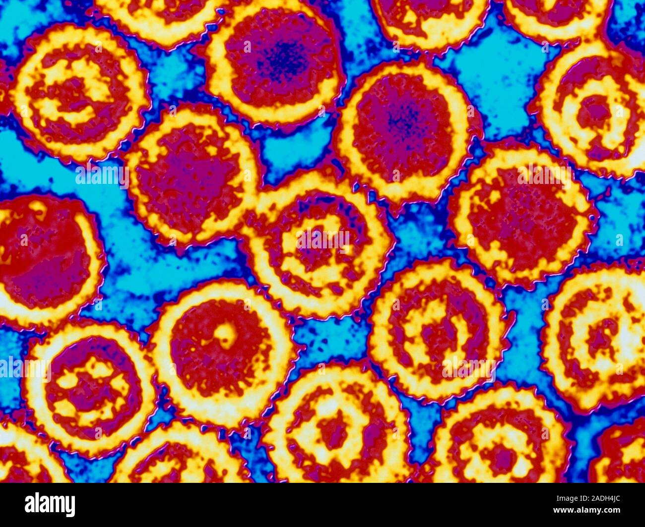 Epstein-Barr viruses, EBV. Coloured Transmission Electron Micrograph (TEM) of Epstein-Barr ...