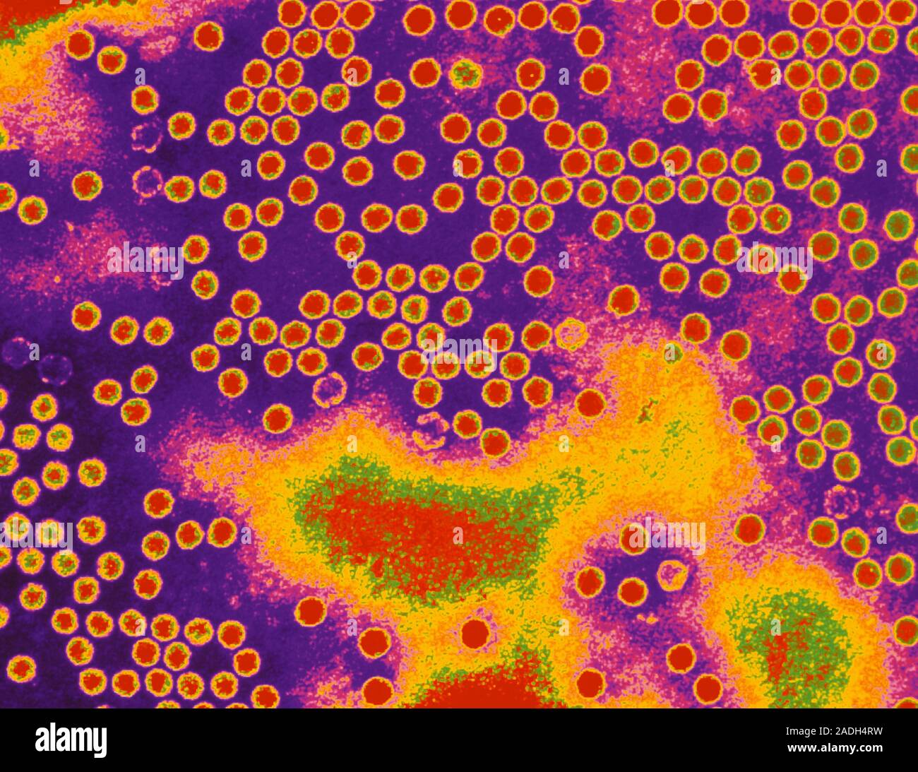 Polio viruses (type 1). Coloured transmission electron micrograph (TEM ...