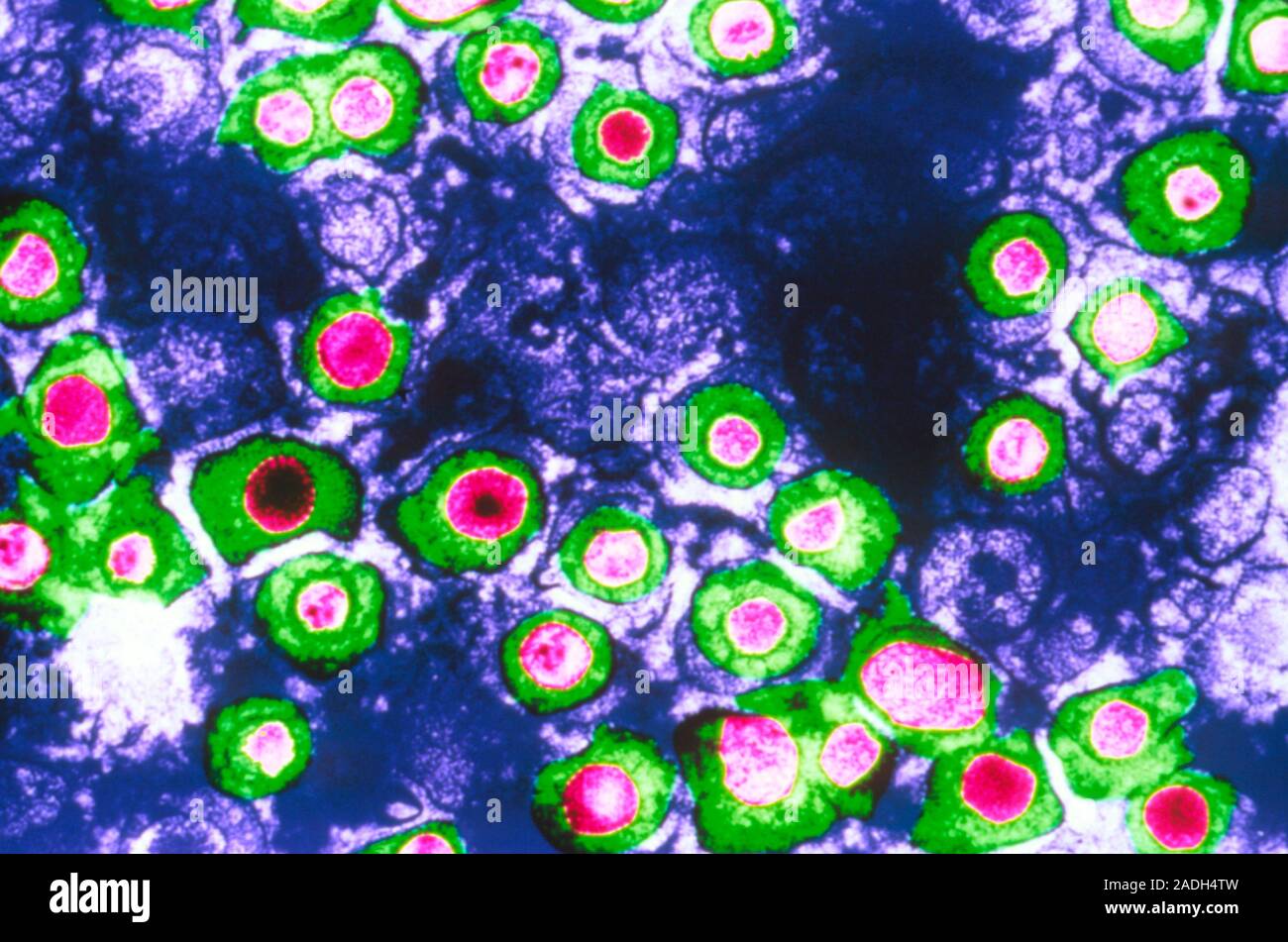 Herpes simplex viruses. Coloured transmission electron micrograph (TEM ... Herpes simplex viruses. Coloured transmission electron micrograph (TEM ...