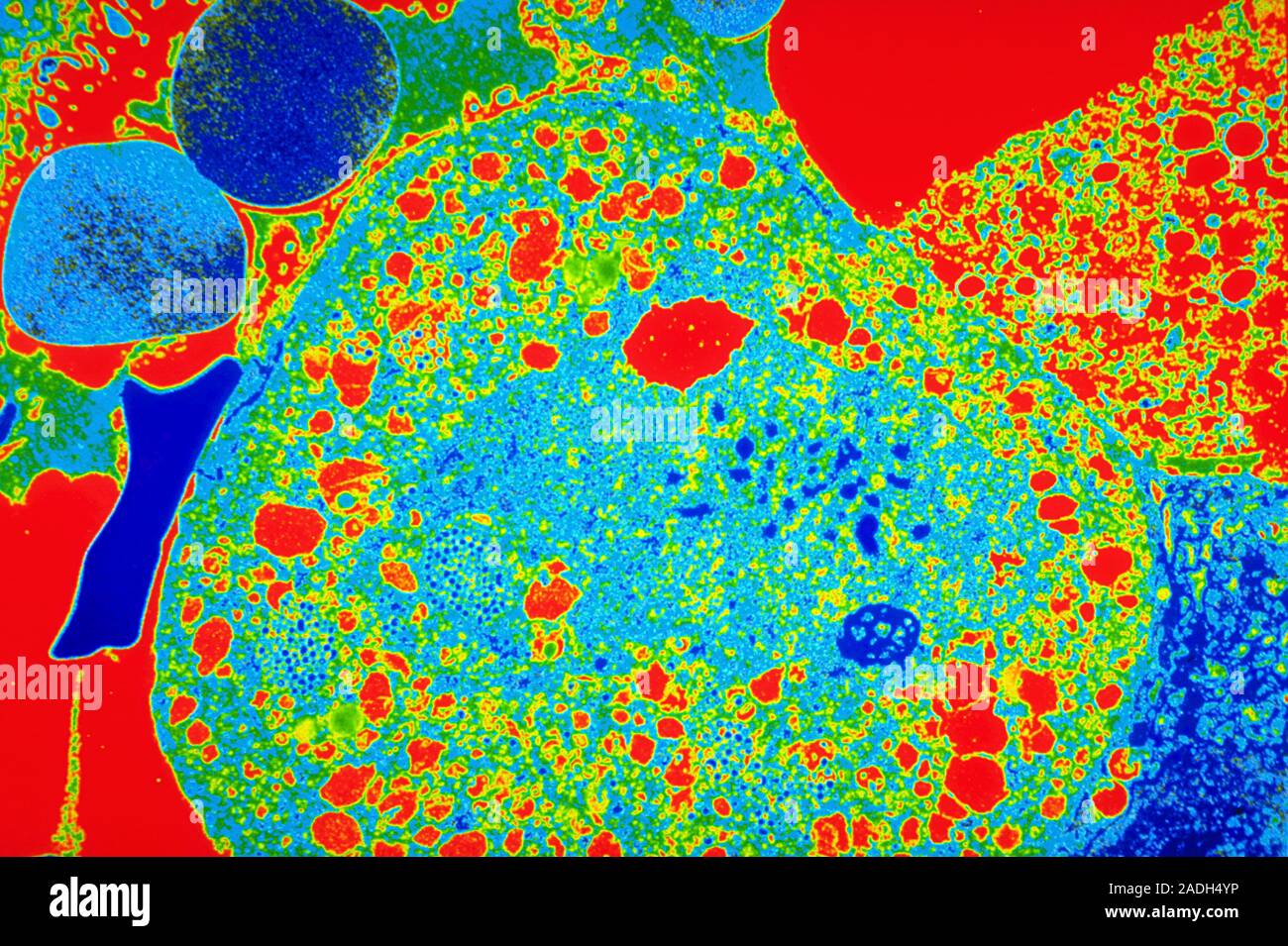 Cytomegalovirus infection. Coloured transmission electron micrograph (TEM) of a section through ...