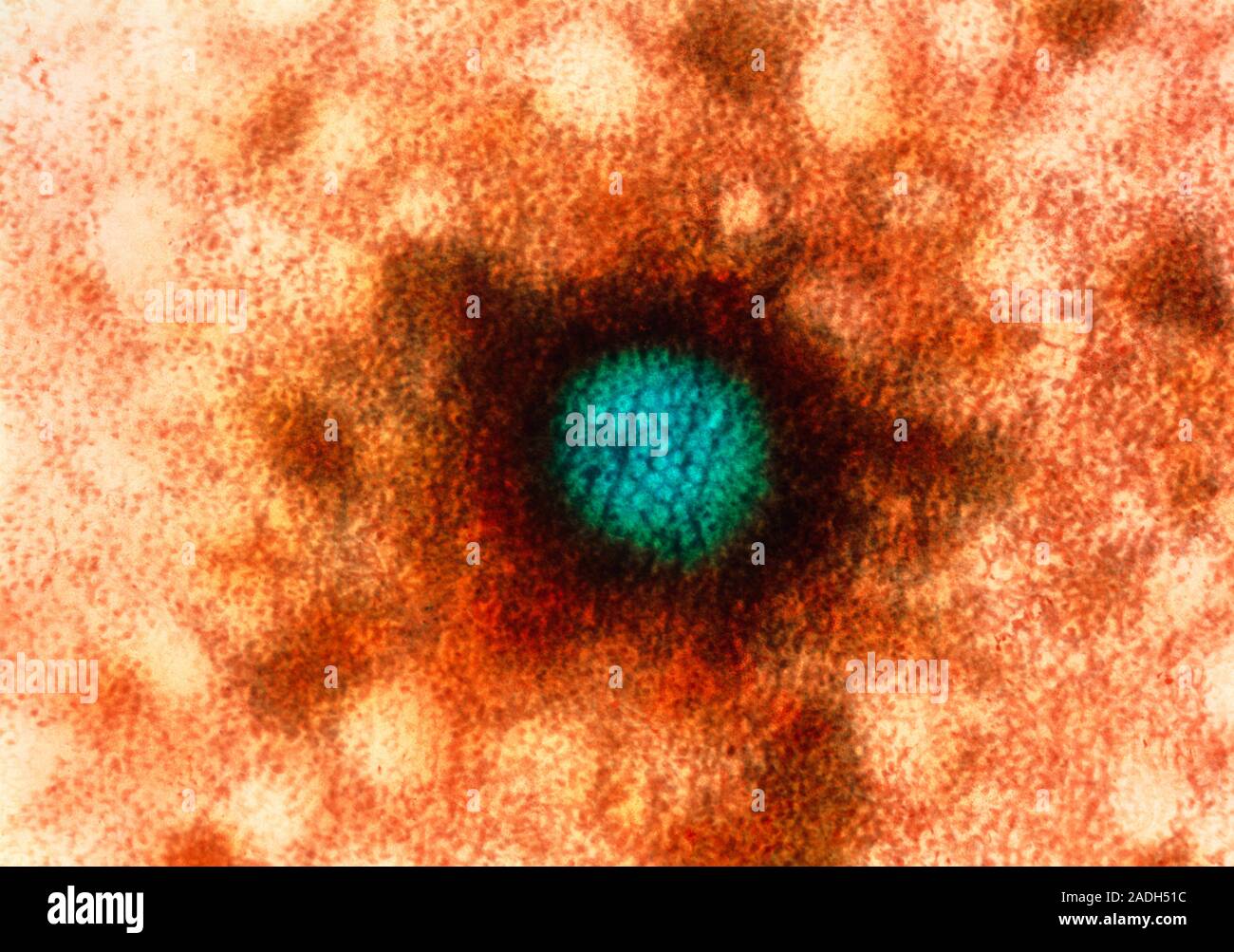 Herpes simplex virus. Coloured transmission electron micrograph (TEM ...