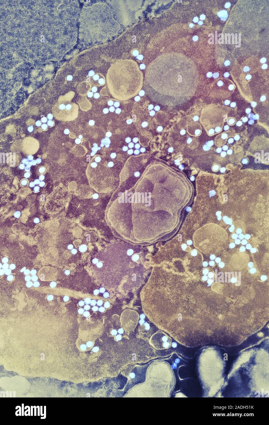 Yellow fever virus particles. Coloured transmission electron micrograph ...